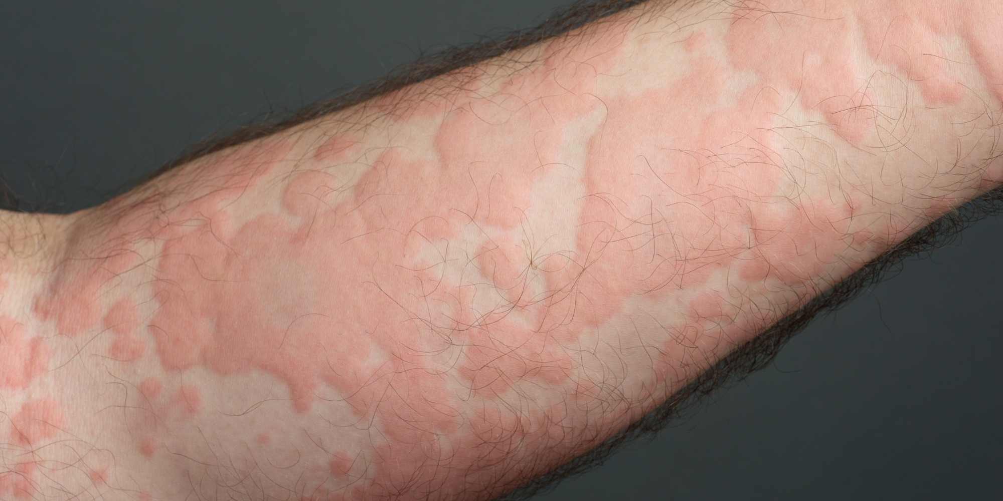 Skin Health for Beginners - GIG® Gluten Intolerance Group®